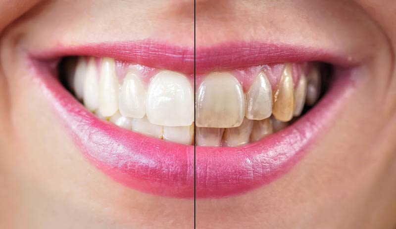 Tooth Discoloration: Causes, Treatment & Prevention
